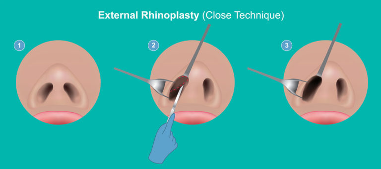 Nasal Tip Plasty - Clifford Surgery